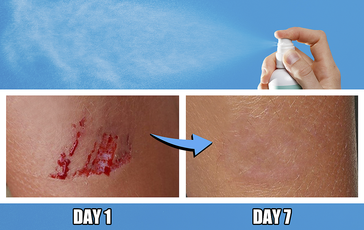 Scientists Discover Revolutionary “Wound Care Spray“ – And It's Finally ...
