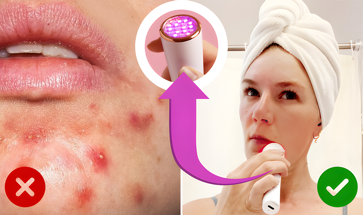 This Strange Device Rescued Me From A Lifetime of Acne, Wrinkles And Humiliating Skin Problems ...